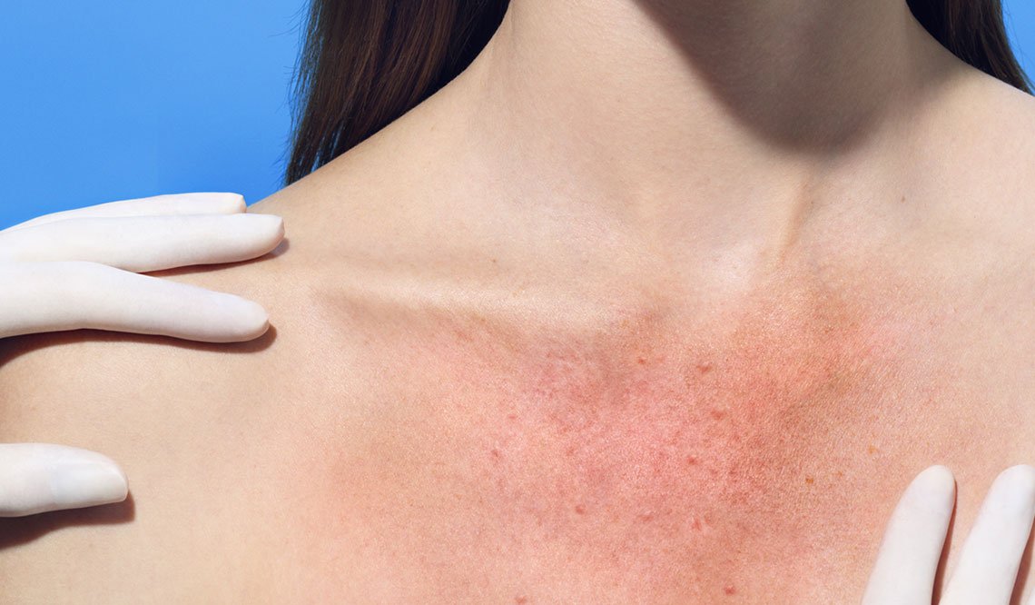 SUN PROTECTION : causes, treatments, products by La Roche-Posay